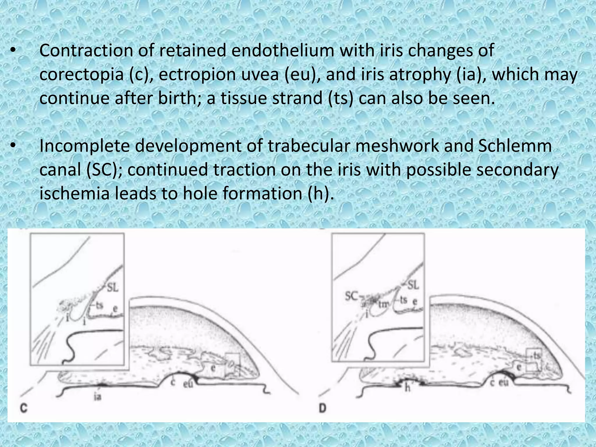 Congenital glaucoma part2; developmental glaucoma | PPTX
