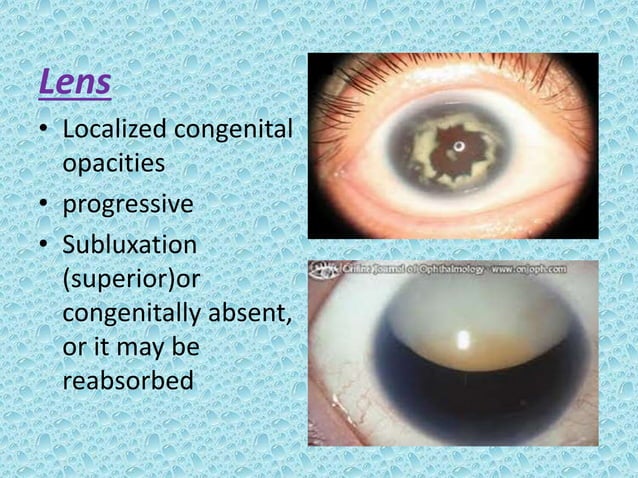 Congenital glaucoma part2; developmental glaucoma | PPTX
