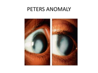 Congenital glaucomas | PPTX