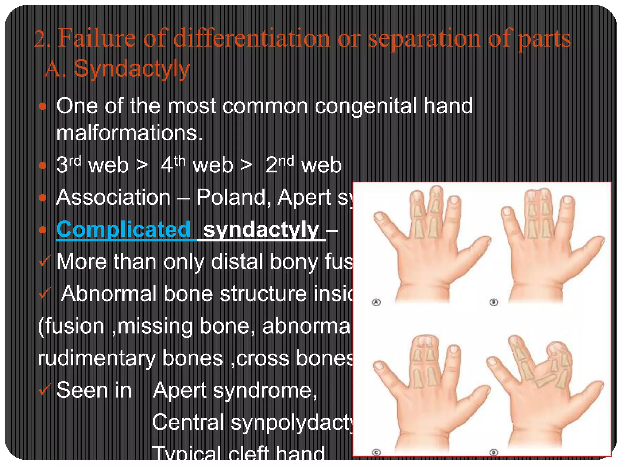 Congenital hand anomalies | PPTX