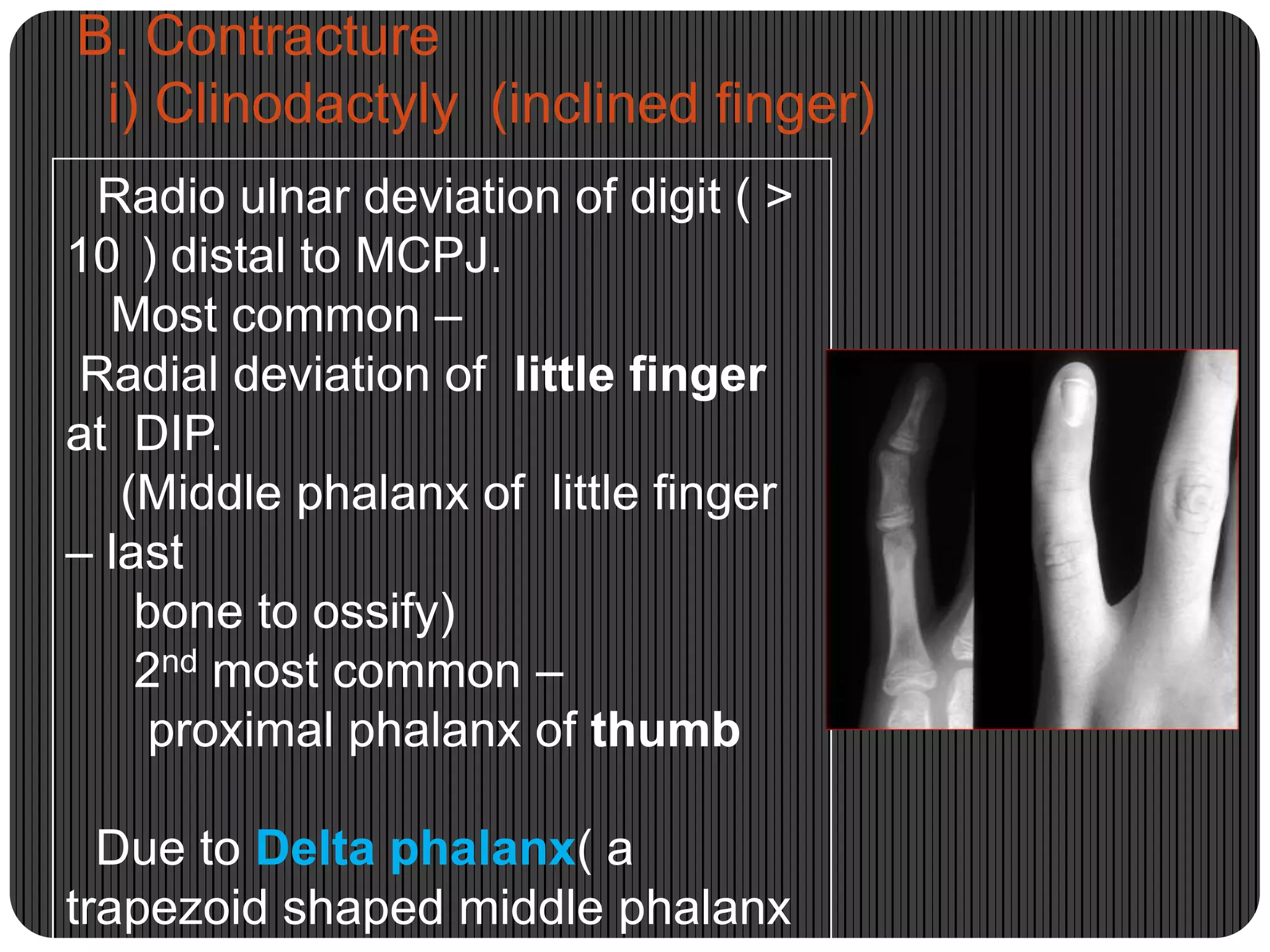 Congenital hand anomalies | PPTX