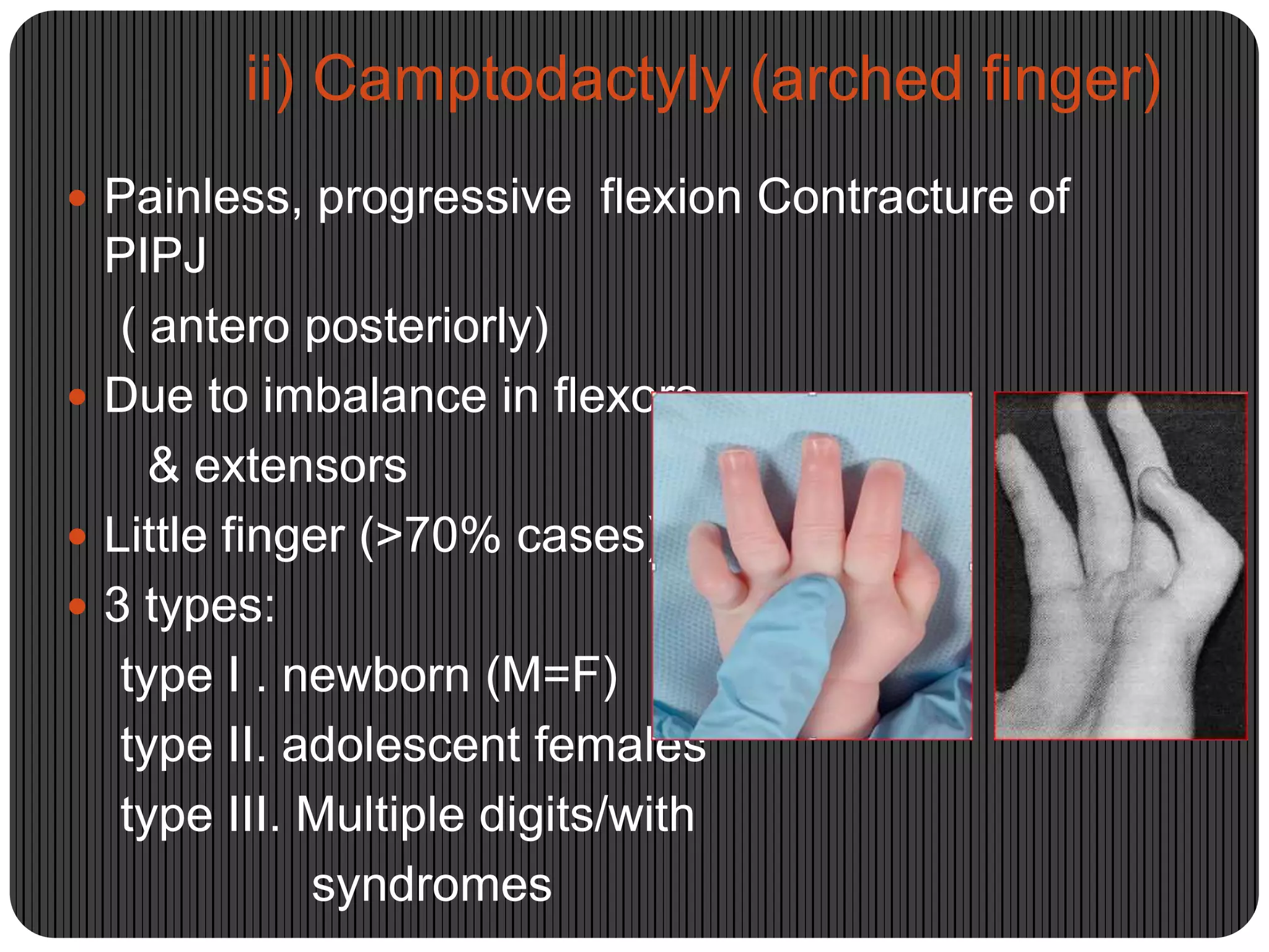 Congenital hand anomalies | PPTX