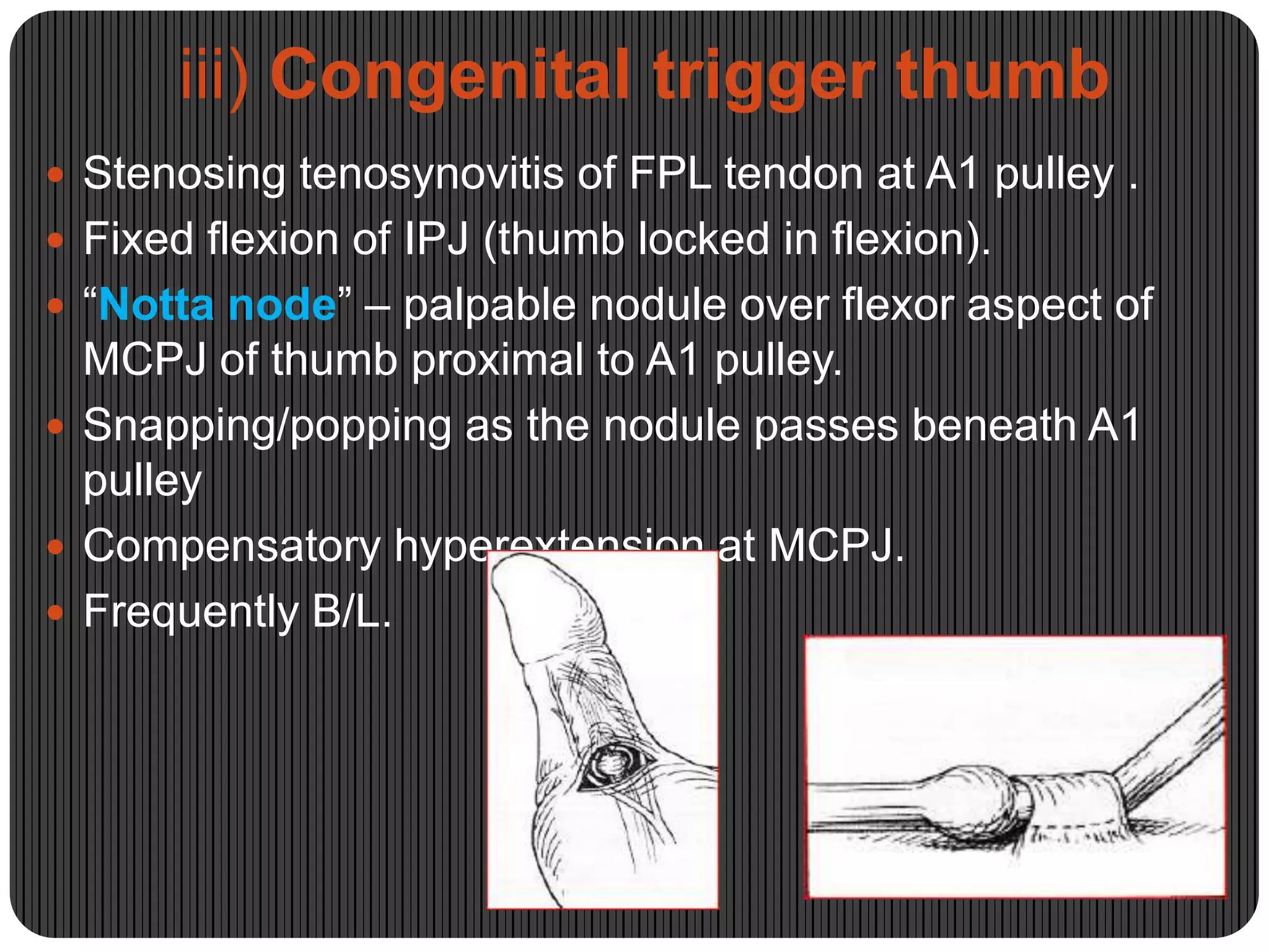 Congenital hand anomalies | PPTX