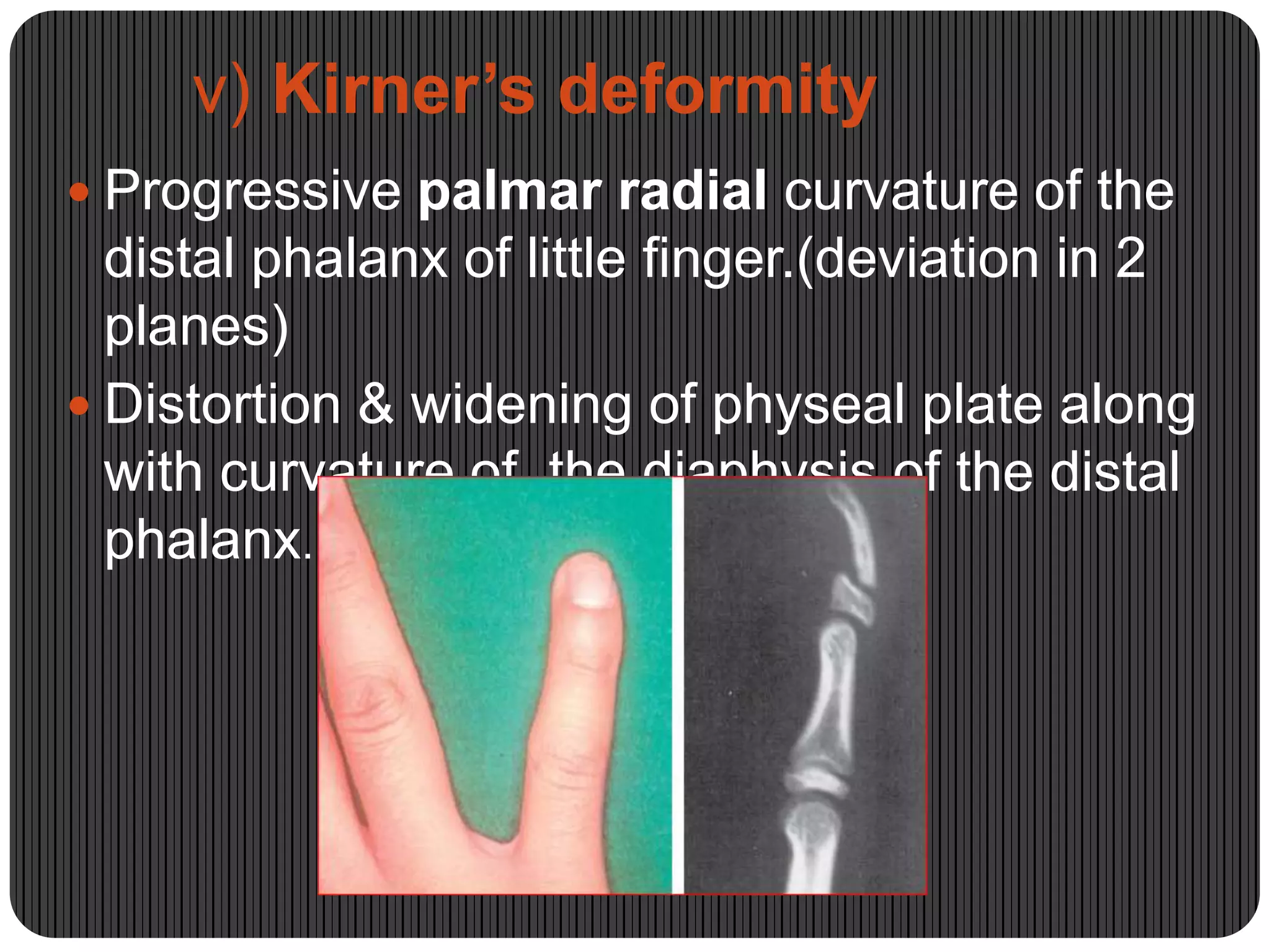 Congenital hand anomalies | PPTX