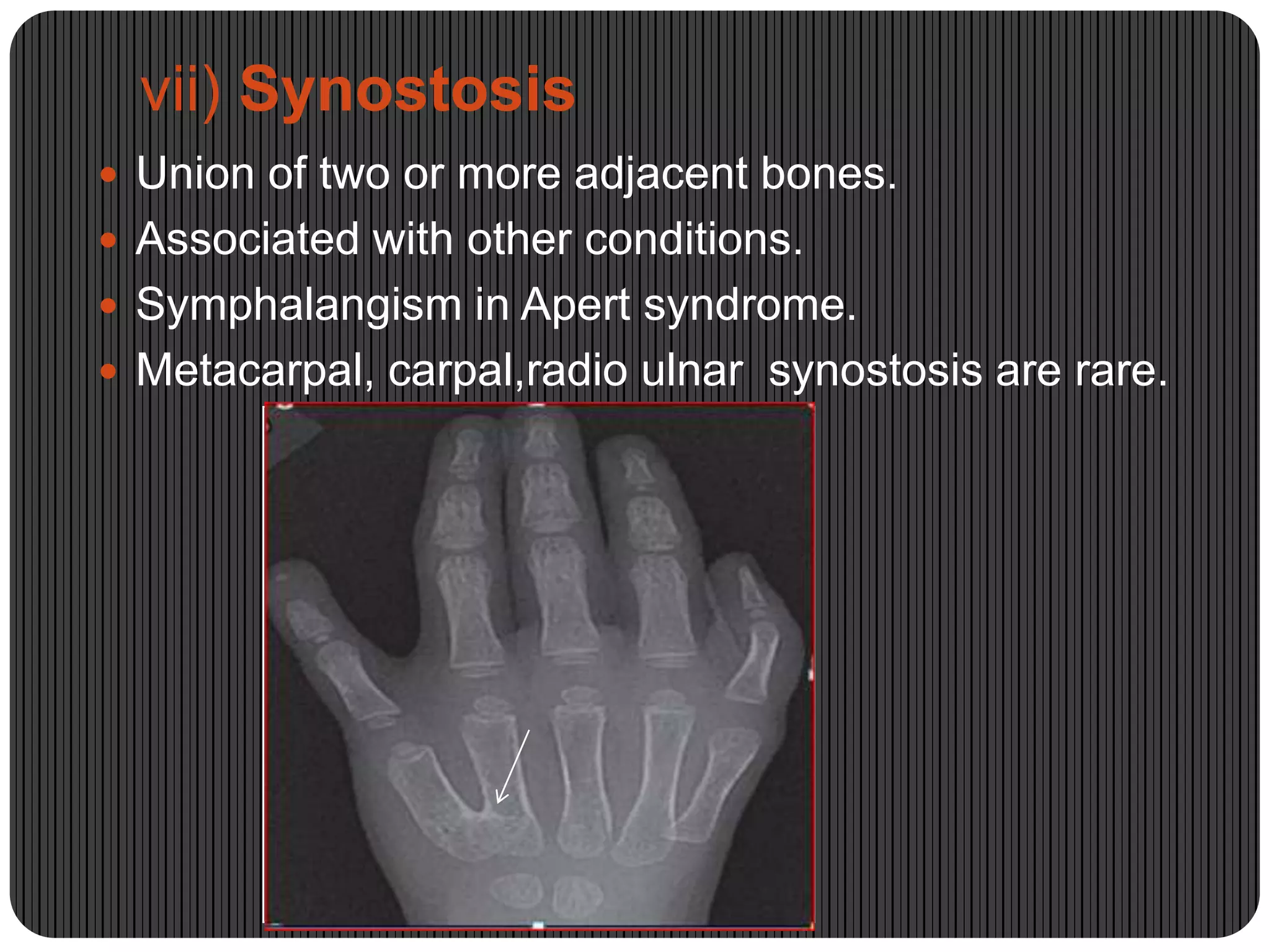 Congenital hand anomalies | PPTX