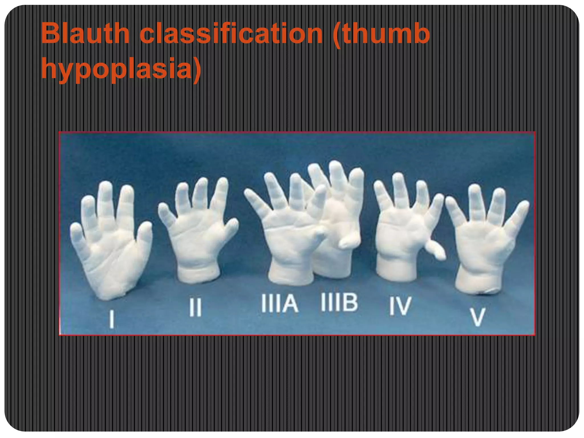 Congenital hand anomalies | PPTX