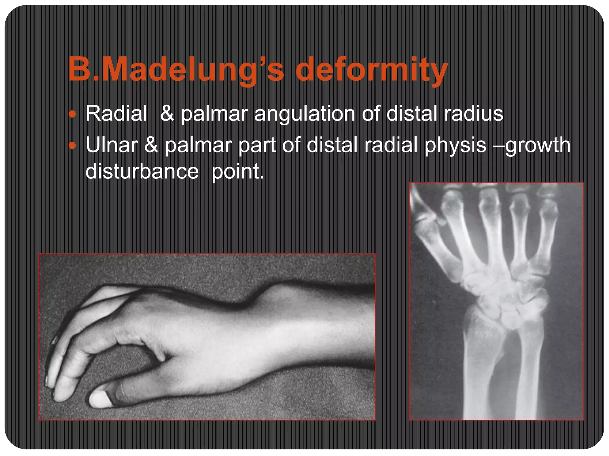 Congenital hand anomalies | PPTX