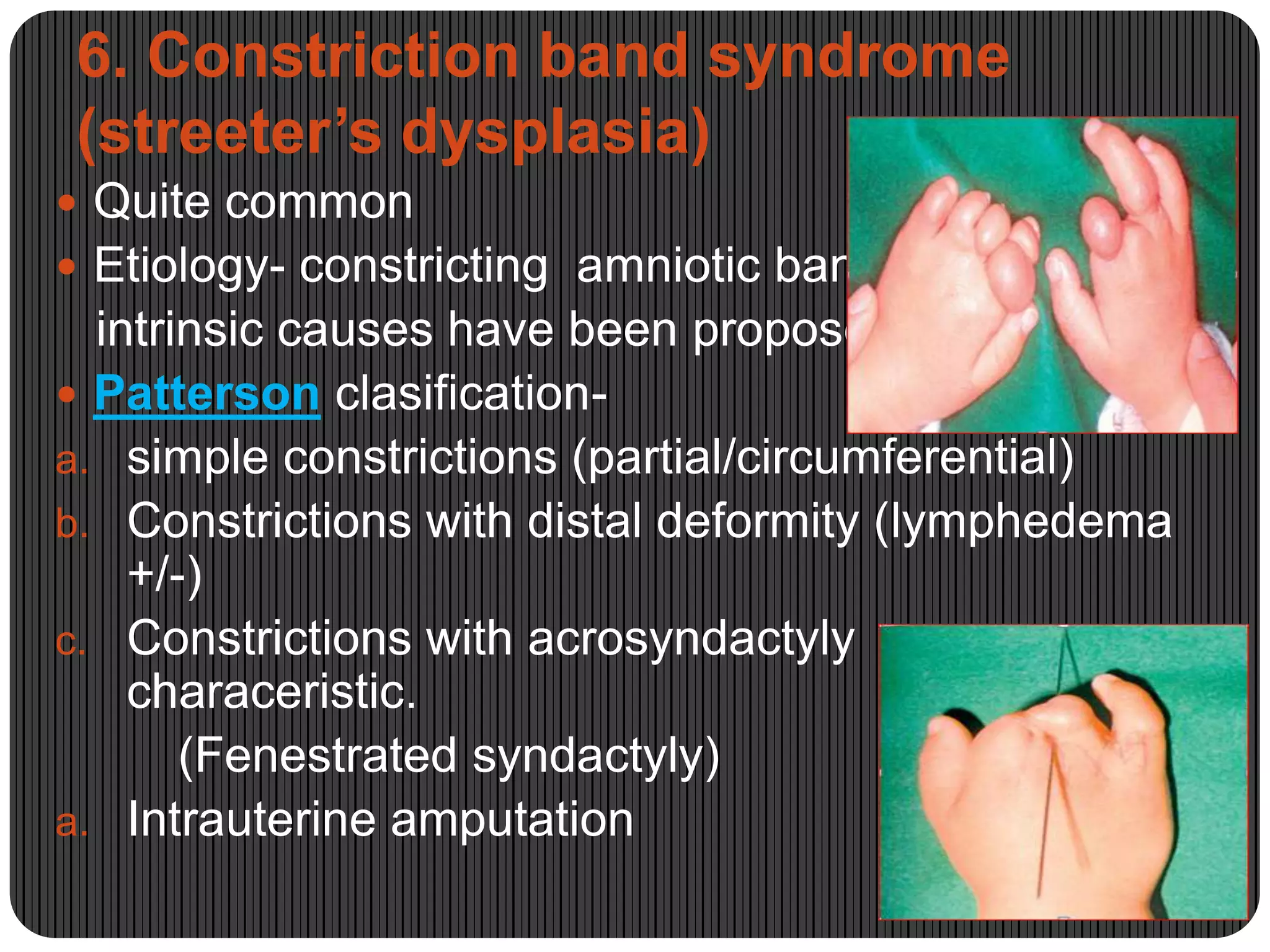 Congenital hand anomalies | PPTX