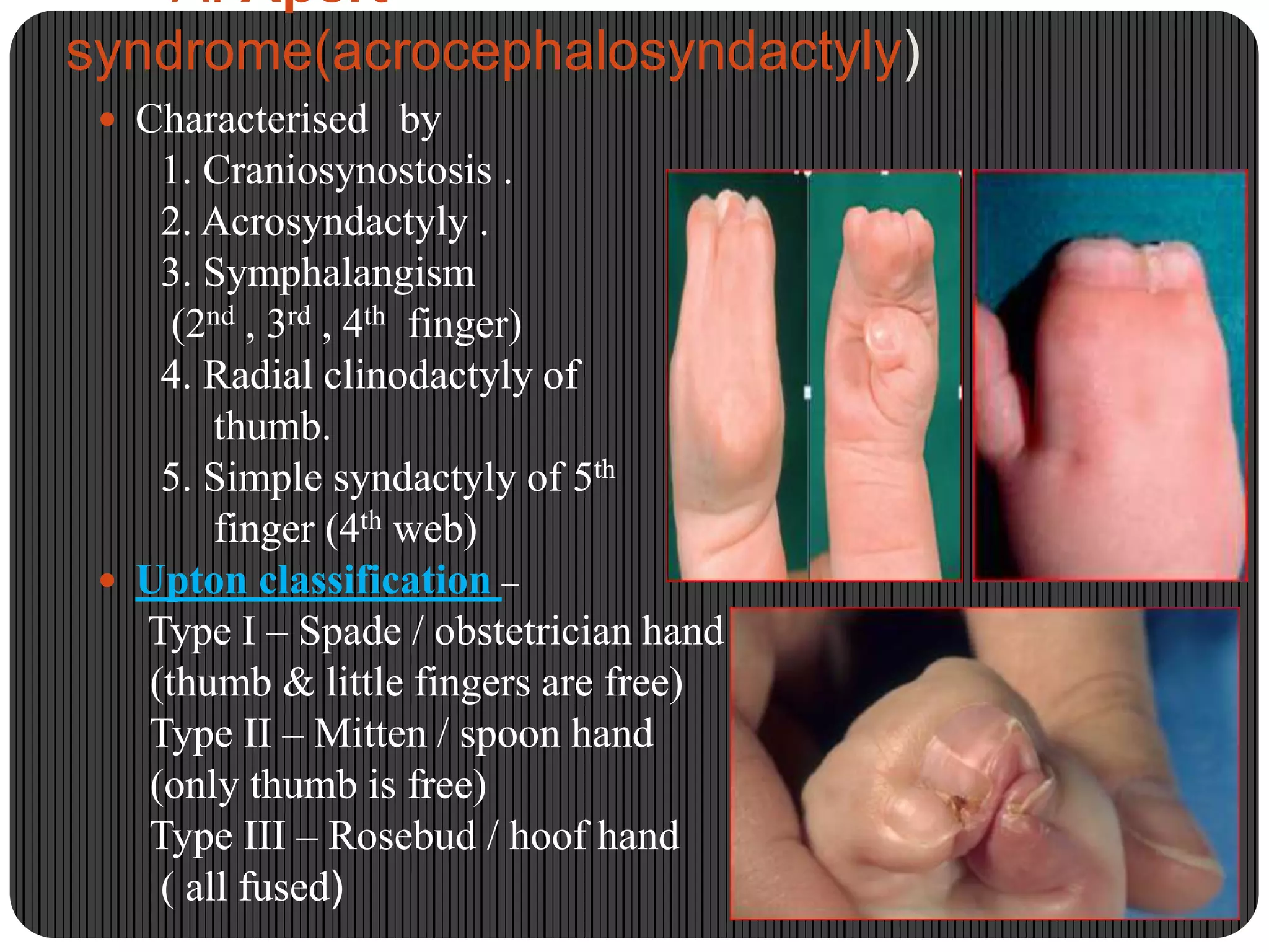 Congenital hand anomalies | PPTX