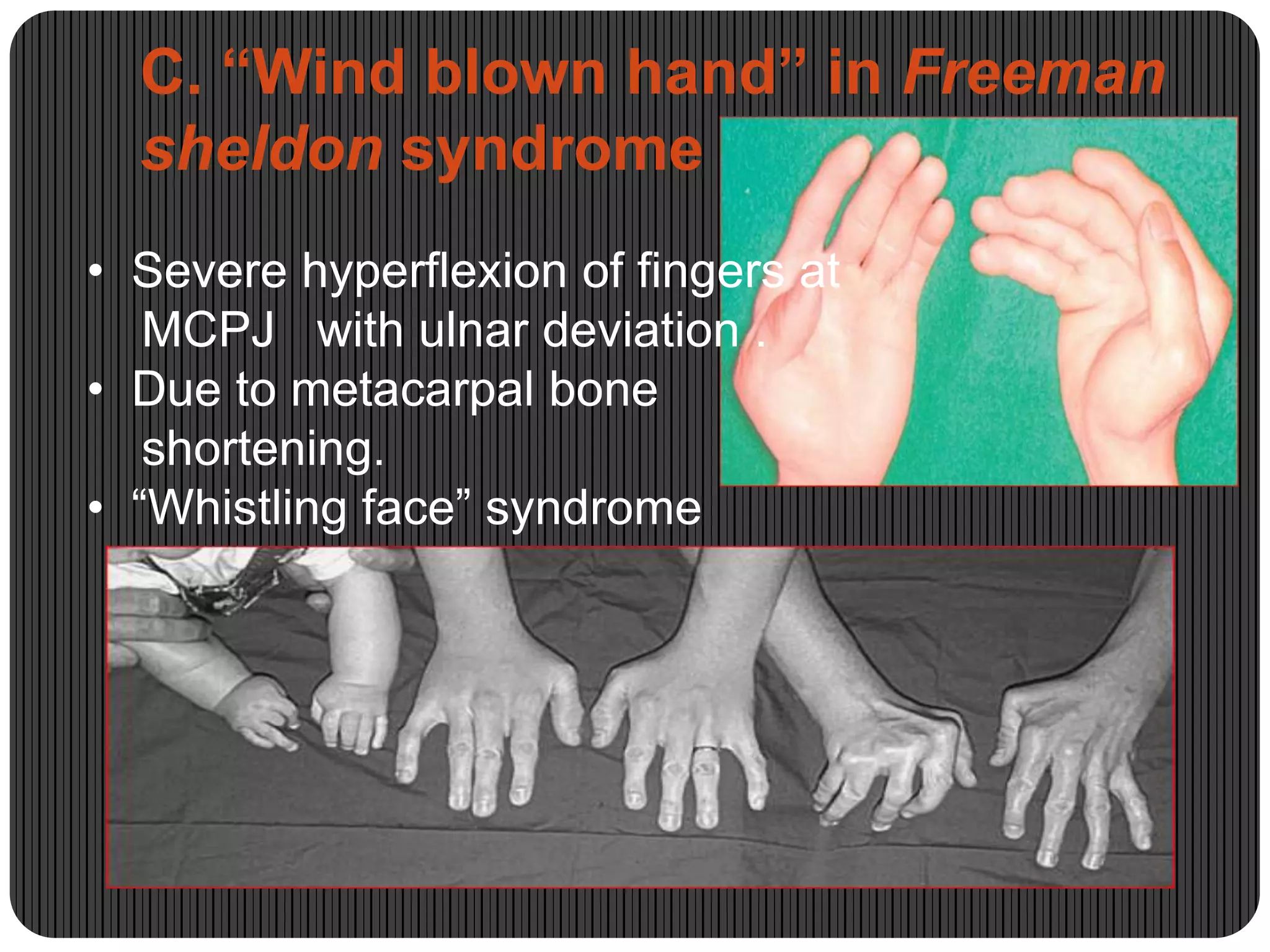 Congenital hand anomalies | PPTX