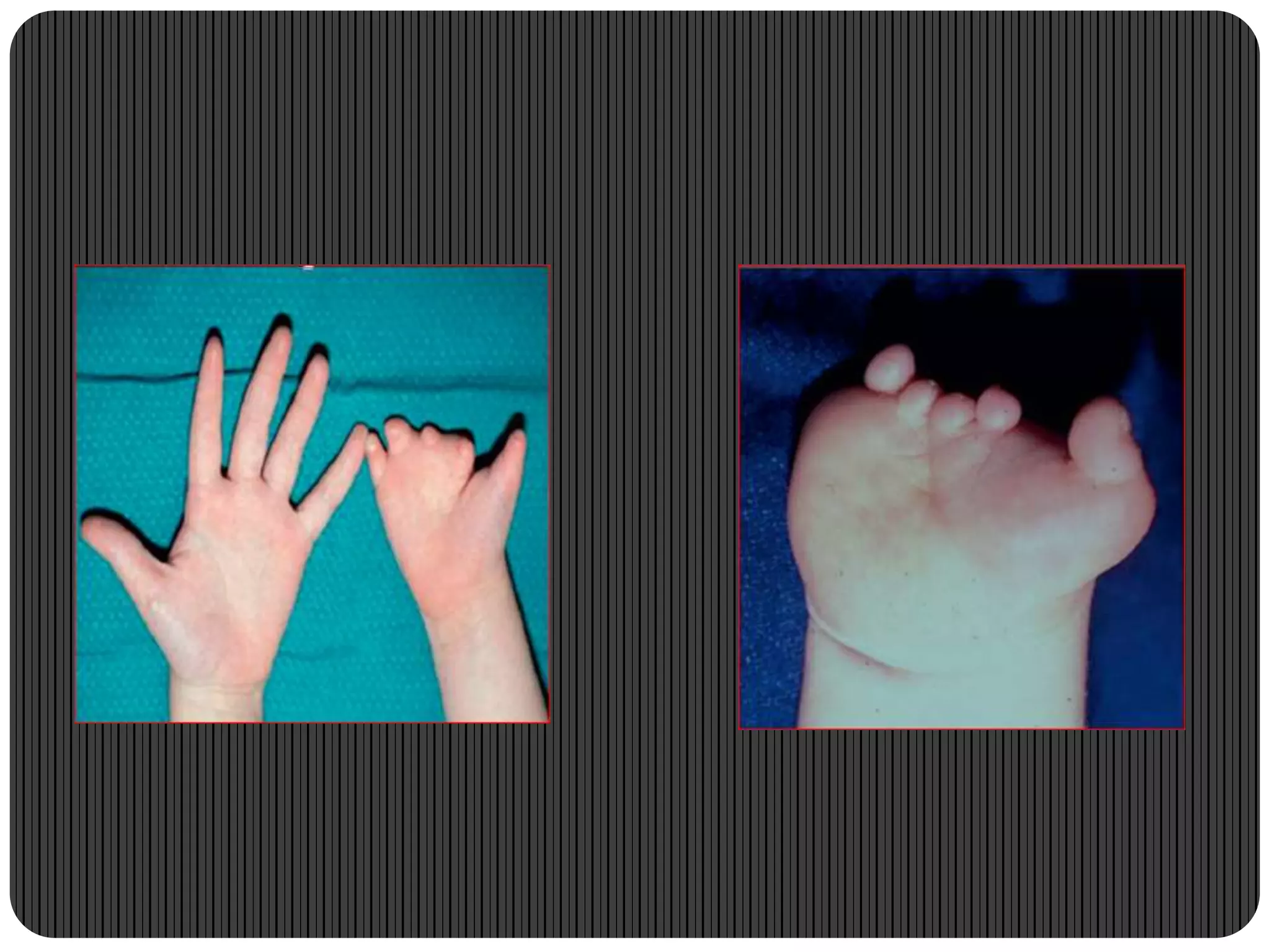 Congenital hand anomalies | PPTX