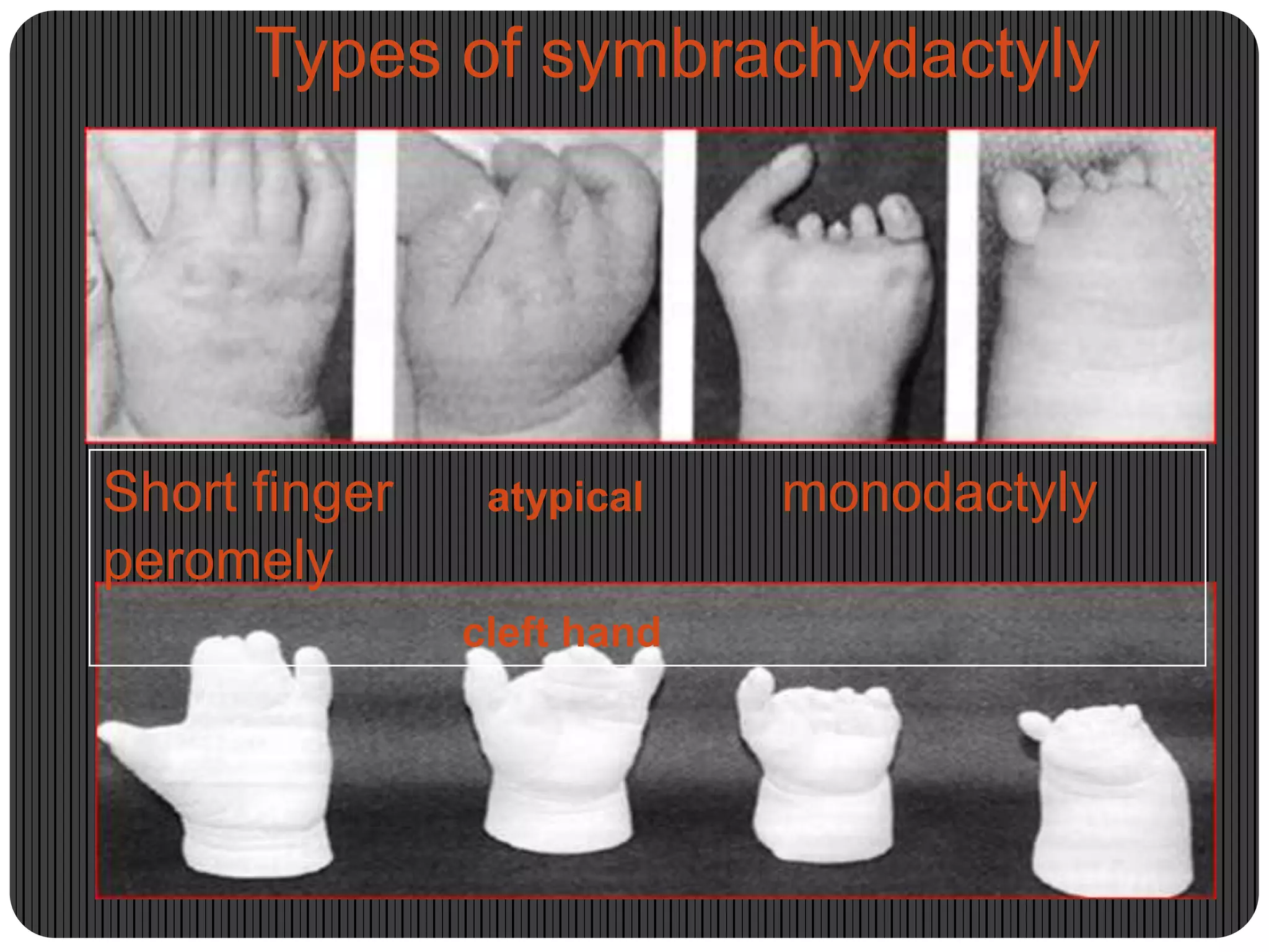 Congenital hand anomalies | PPTX