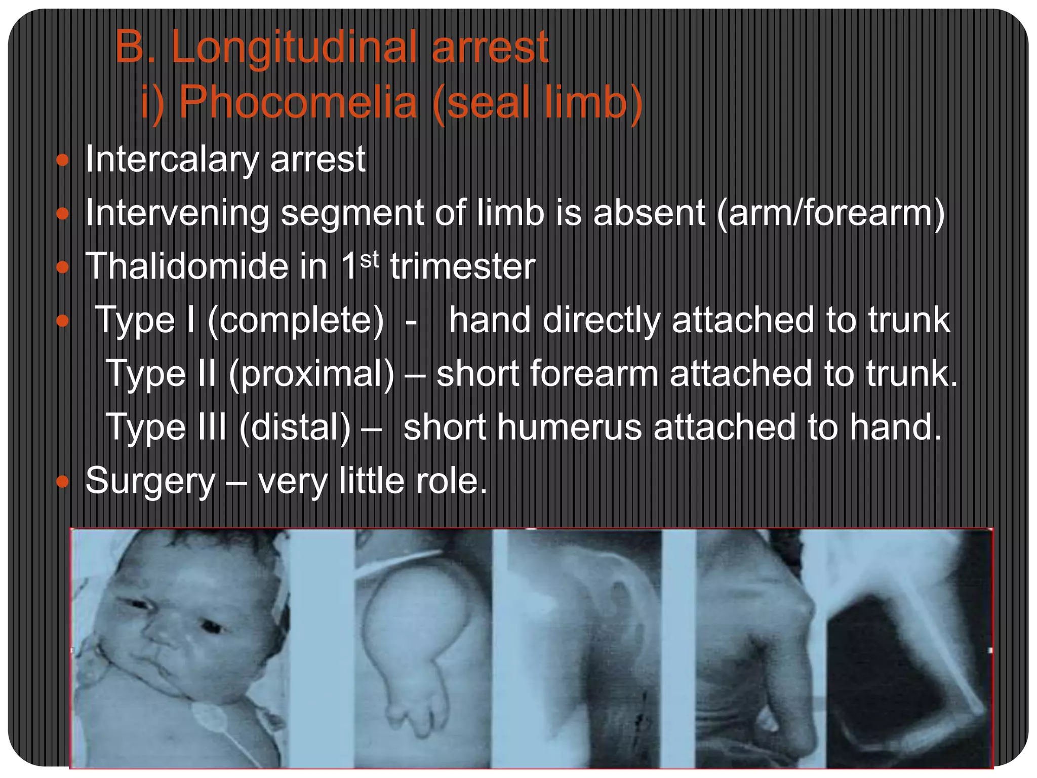 Congenital hand anomalies | PPTX