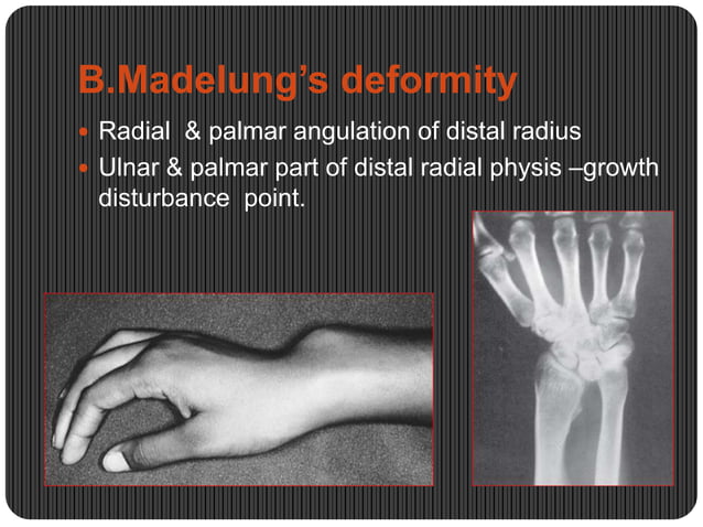 Congenital hand anomalies | PPTX