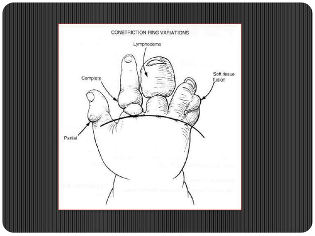 Congenital hand anomalies | PPTX