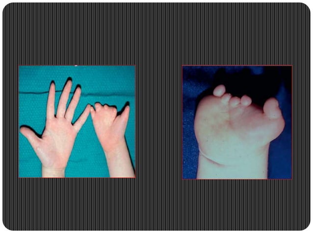 Congenital hand anomalies | PPTX