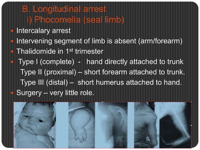 Congenital hand anomalies | PPTX