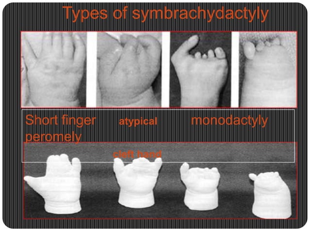 Congenital hand anomalies
