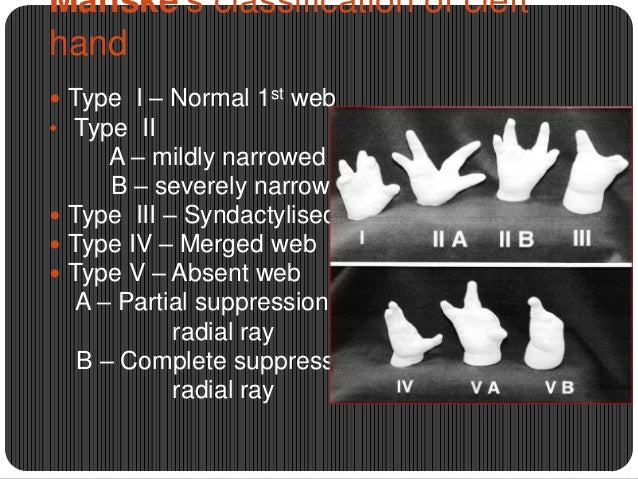 Congenital hand anomalies