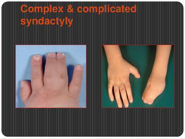 Stiff Fingers Congenital Hand And Arm Differences