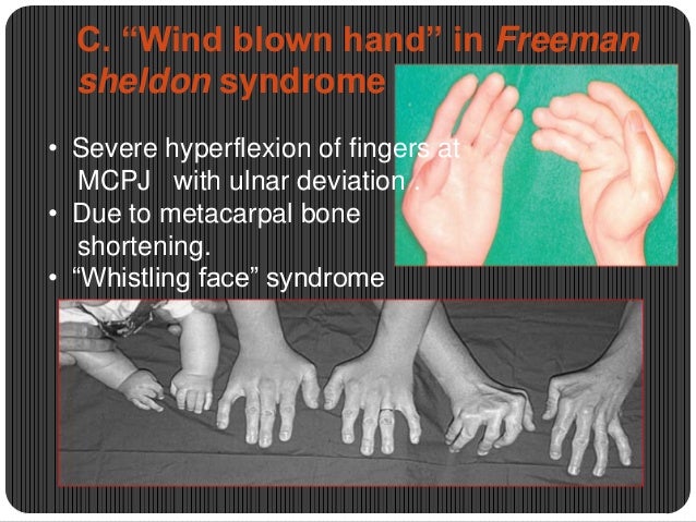 Congenital hand anomalies