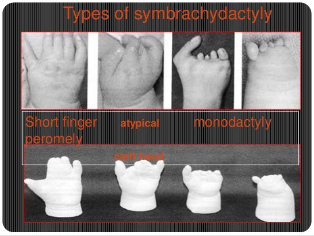 Congenital hand anomalies