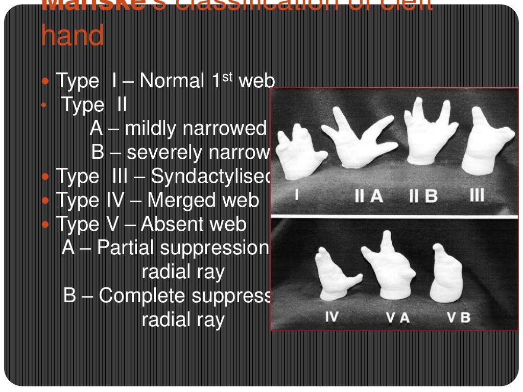 Classification Of Congenital Deformities Of Hands And - vrogue.co