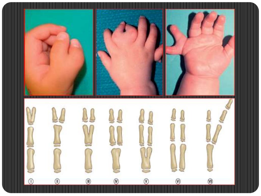 Congenital hand anomalies
