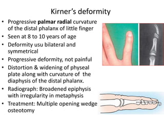Congenital hand anomalies | PPTX