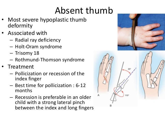 Congenital hand anomalies