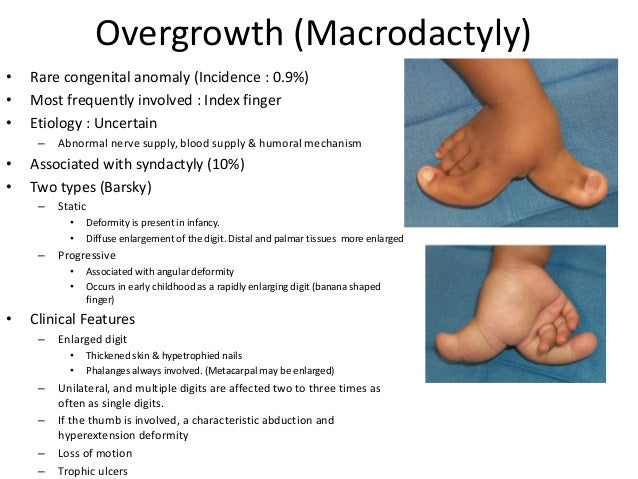 Congenital hand anomalies