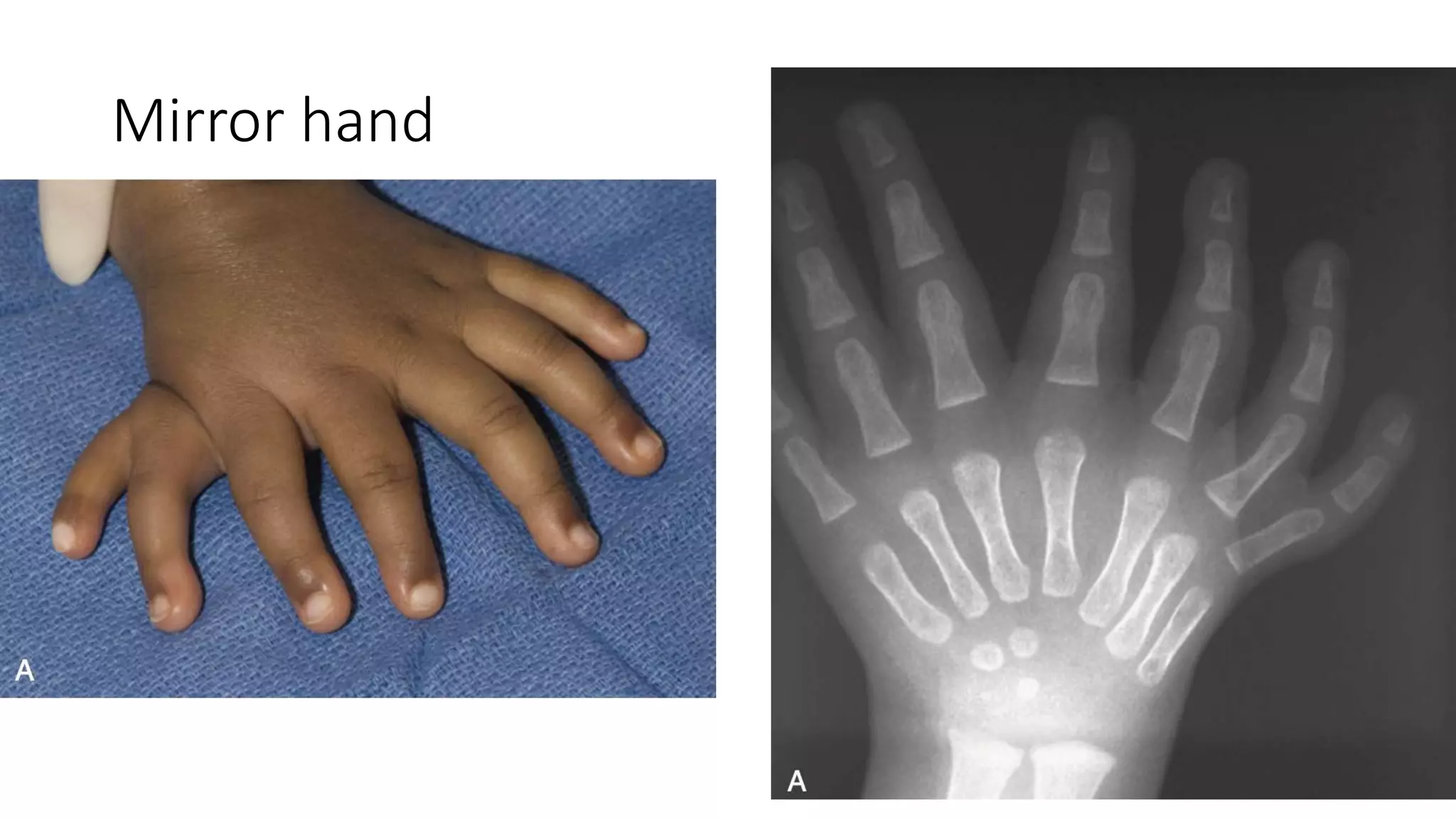 Congenital hand deformities copy | PPTX