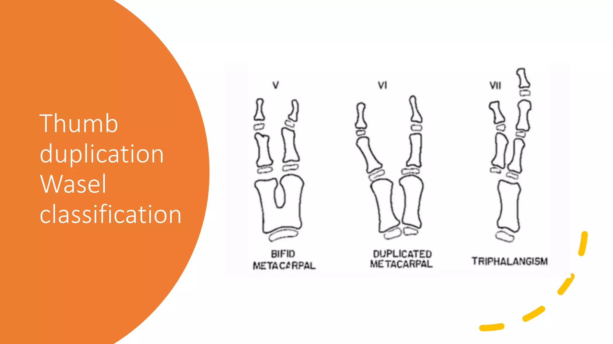 Congenital hand deformities copy | PPTX