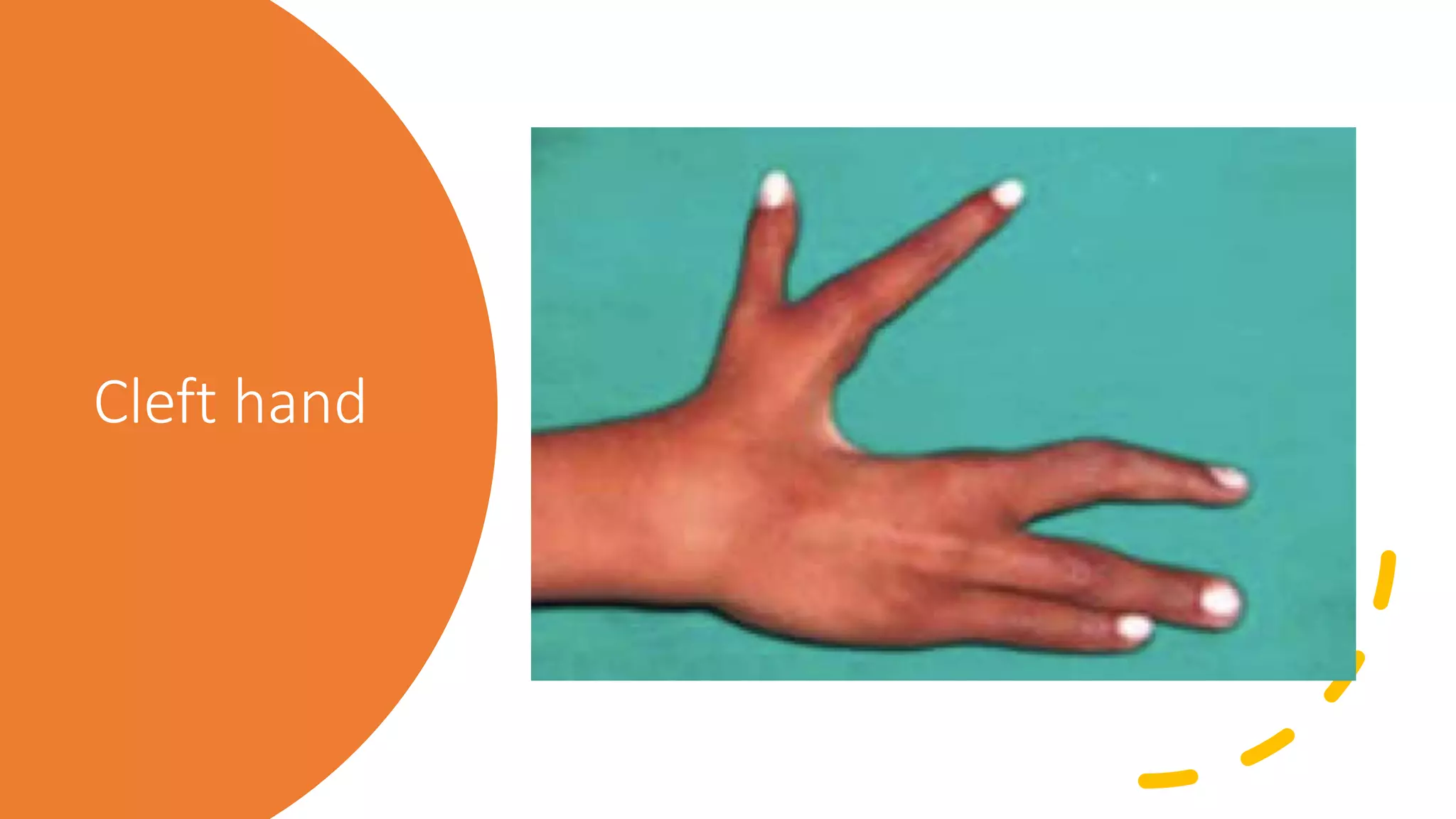Congenital hand deformities copy | PPTX