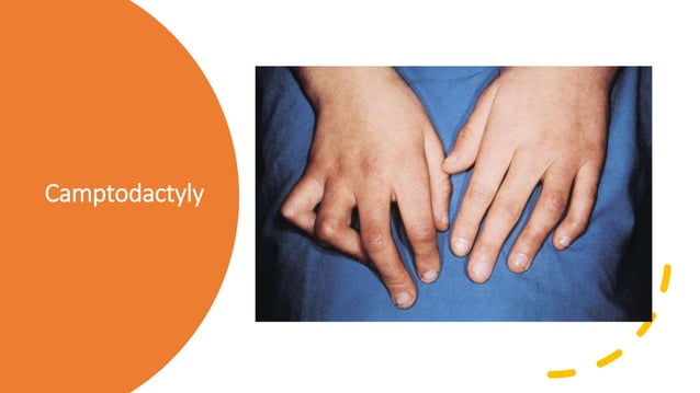 Congenital hand deformities copy | PPTX | Physical Therapy | Wellness
