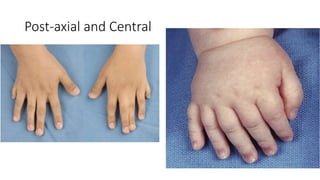 Congenital hand deformities copy | PPTX