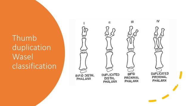 Congenital hand deformities copy | PPTX | Physical Therapy | Wellness