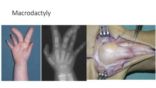 Congenital hand deformities copy | PPTX