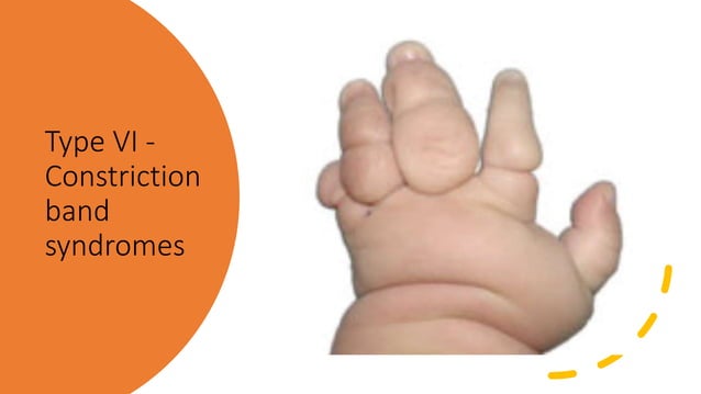 Congenital hand deformities copy | PPTX | Physical Therapy | Wellness