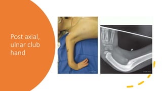 Congenital hand deformities copy | PPTX