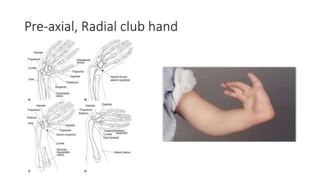 Congenital hand deformities copy | PPTX | Physical Therapy | Wellness