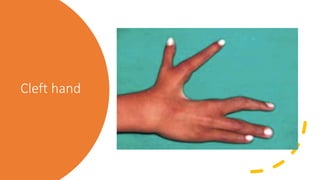 Congenital hand deformities copy | PPTX | Physical Therapy | Wellness