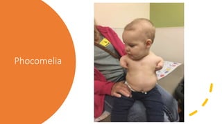 Congenital hand deformities copy | PPTX