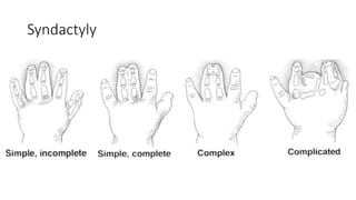 Congenital hand deformities copy | PPTX