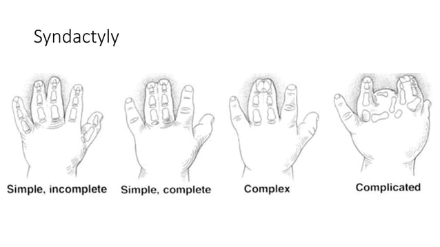 Congenital hand deformities copy | PPTX | Physical Therapy | Wellness