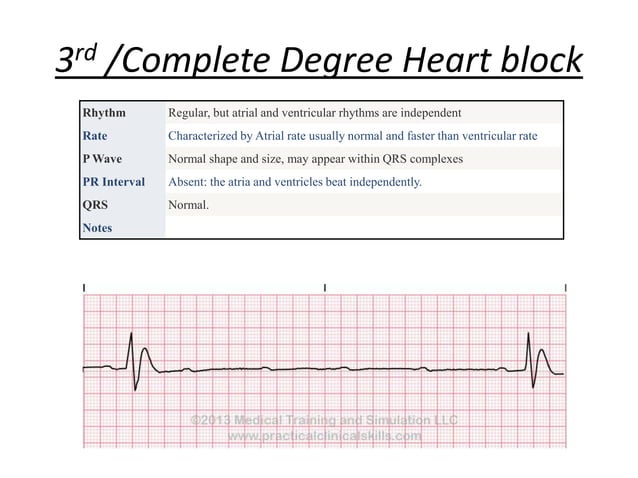 Congenital heart block | PPTX | Pregnancy | Reproductive Health
