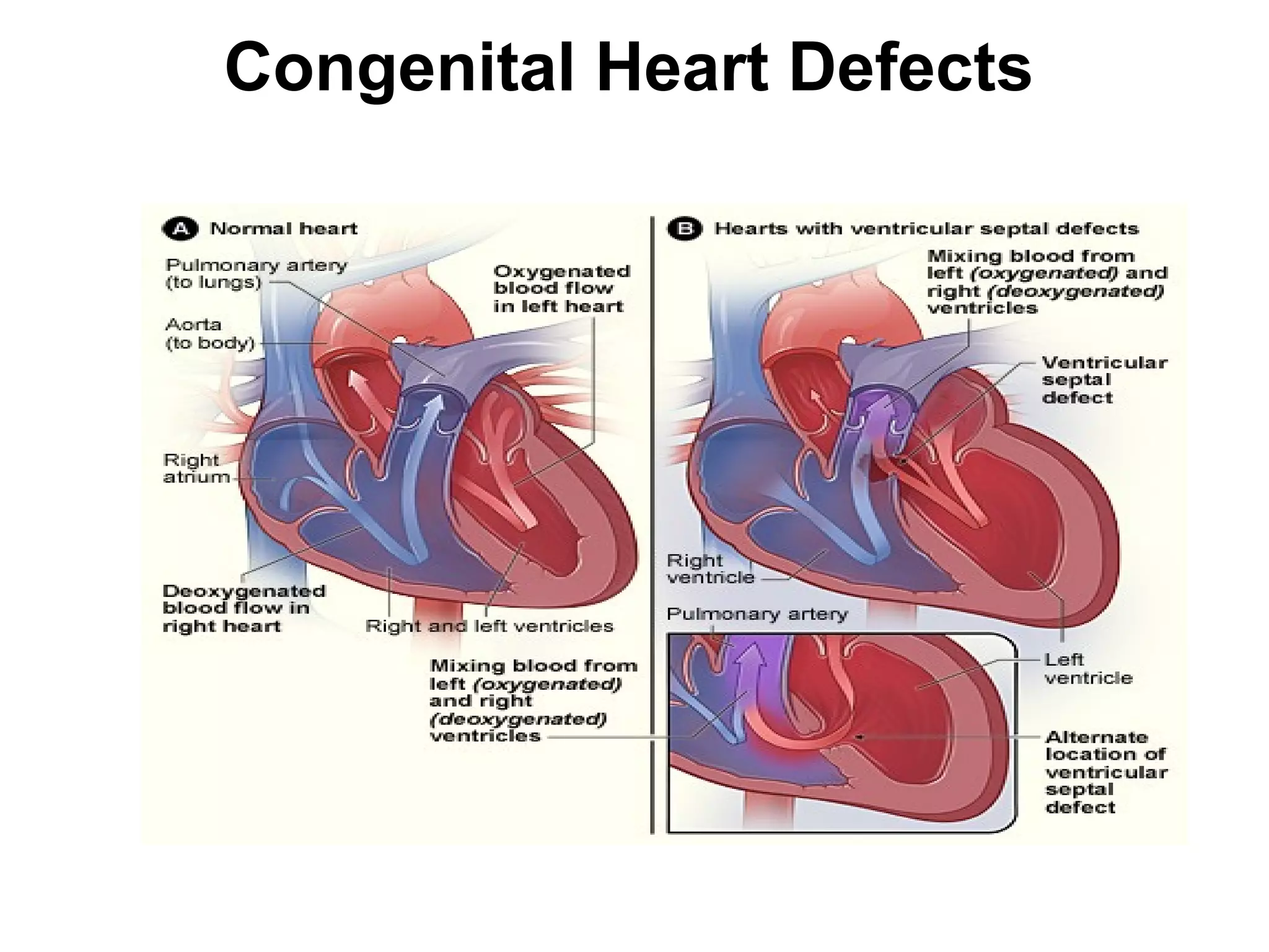 Congenital heart defects | PPT