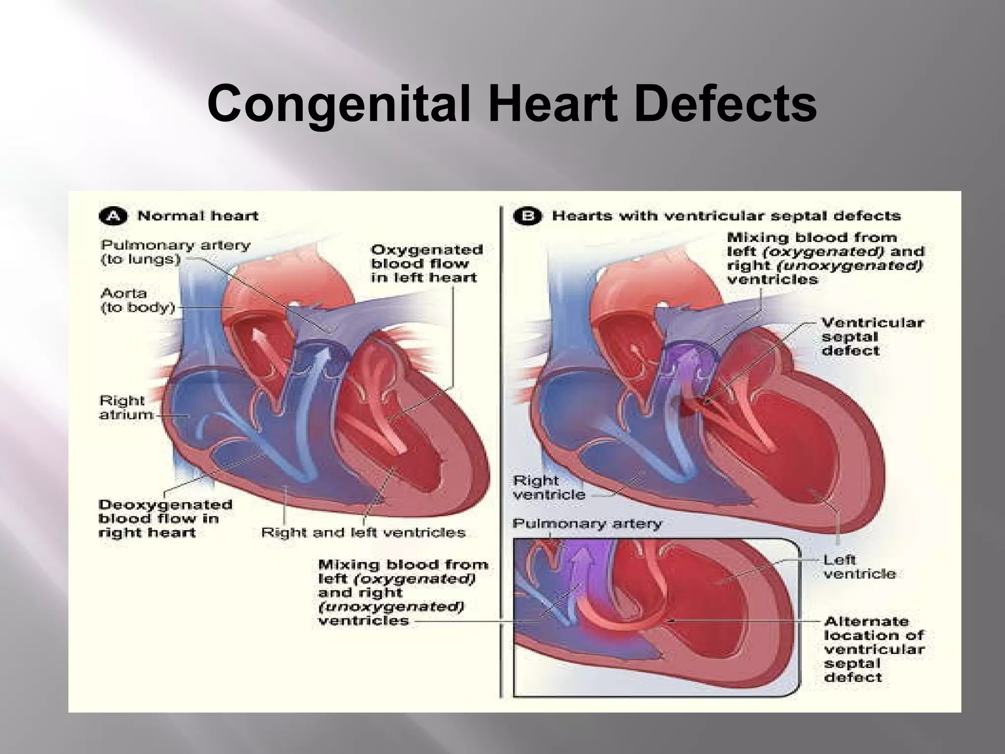 Congenital heart defects | PPT