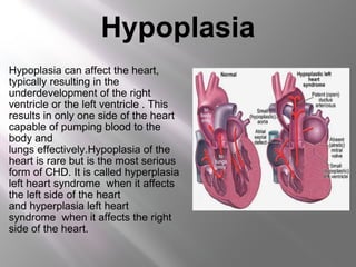 Congenital heart defects | PPT