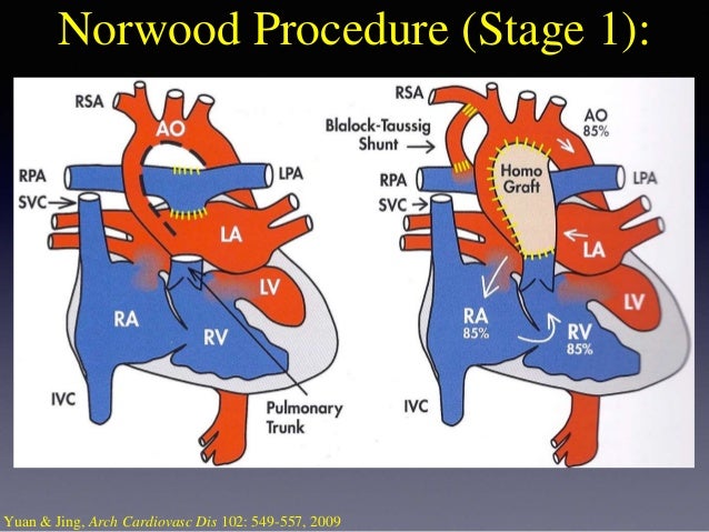 Congenital Heart Defects